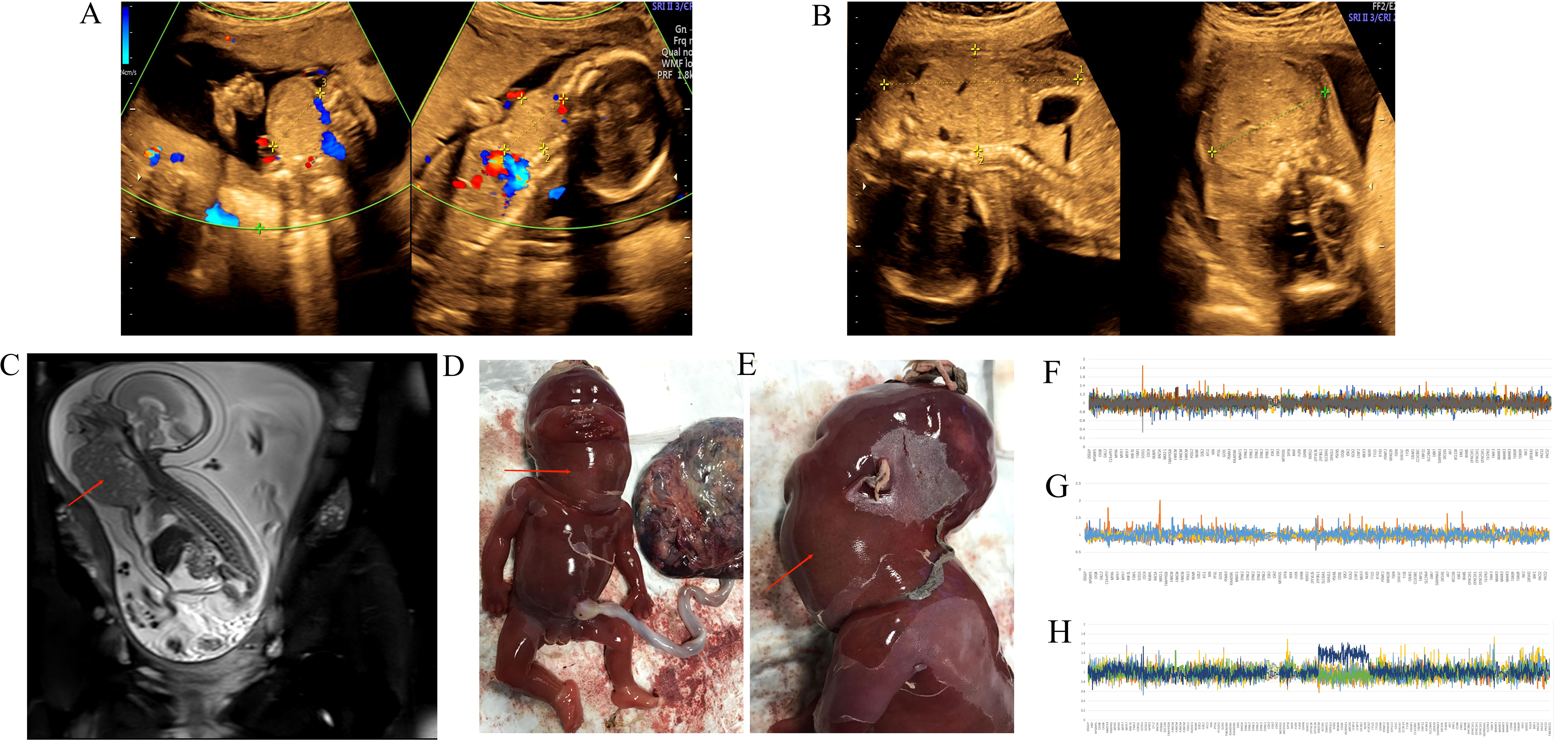 Frontiers Case Report Fetal Cervical Immature Teratoma And Copy
