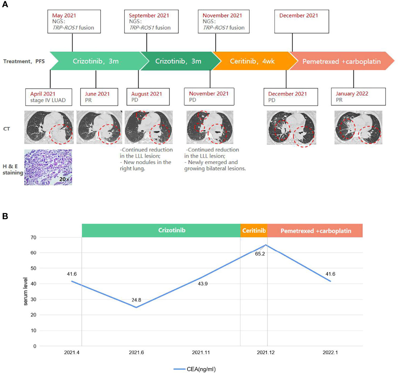 Frontiers Case Report Short Term Response To First Line Crizotinib