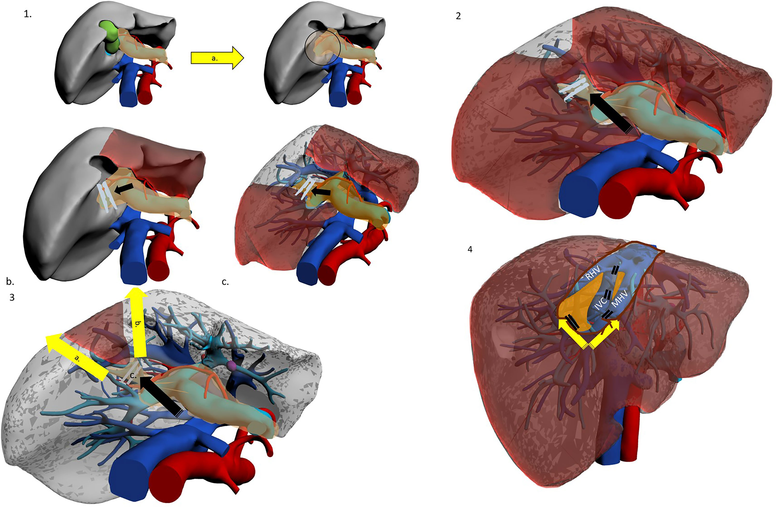 Frontiers All The Routes For Laparoscopic Liver Segment Viii