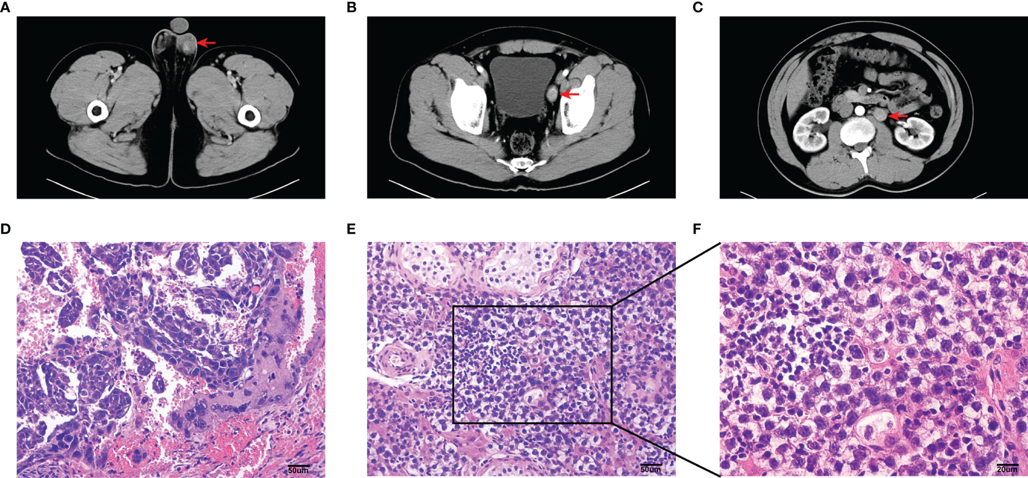 Frontiers Single Cell Rna Sequencing Of Metastatic Testicular