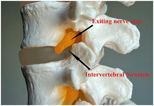 Frontiers Transforaminal Endoscopic Discectomy Under General And