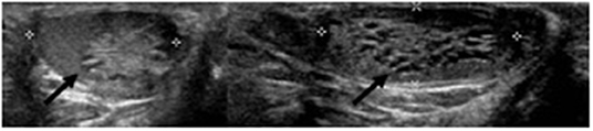 Frontiers Cystic Dysplasia Of The Rete Testis Case Report And