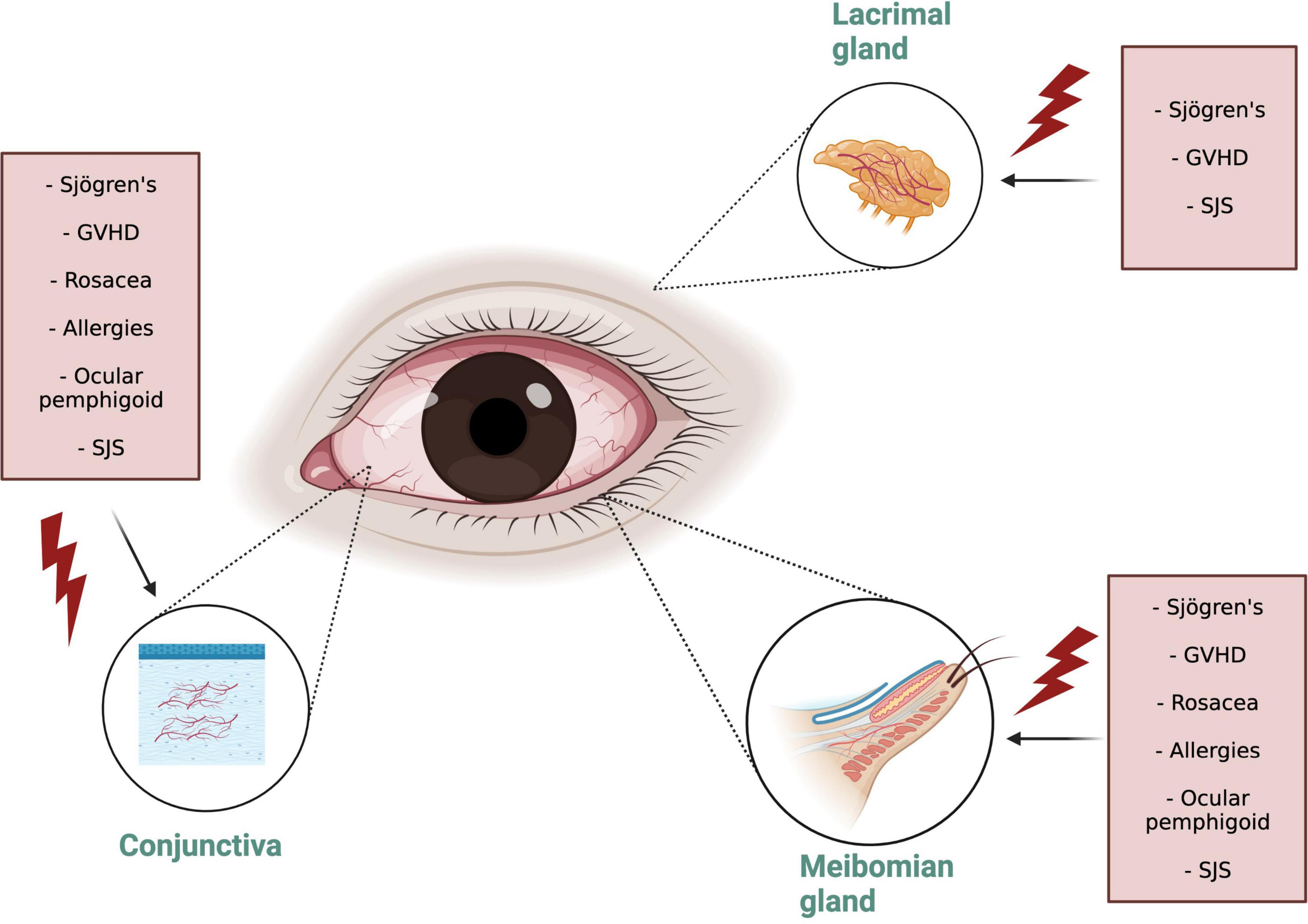 Frontiers Ocular Surface Inflammatory Disorders OSID A Collective Frontiers Ocular Surface Inflammatory Disorders OSID A Collective