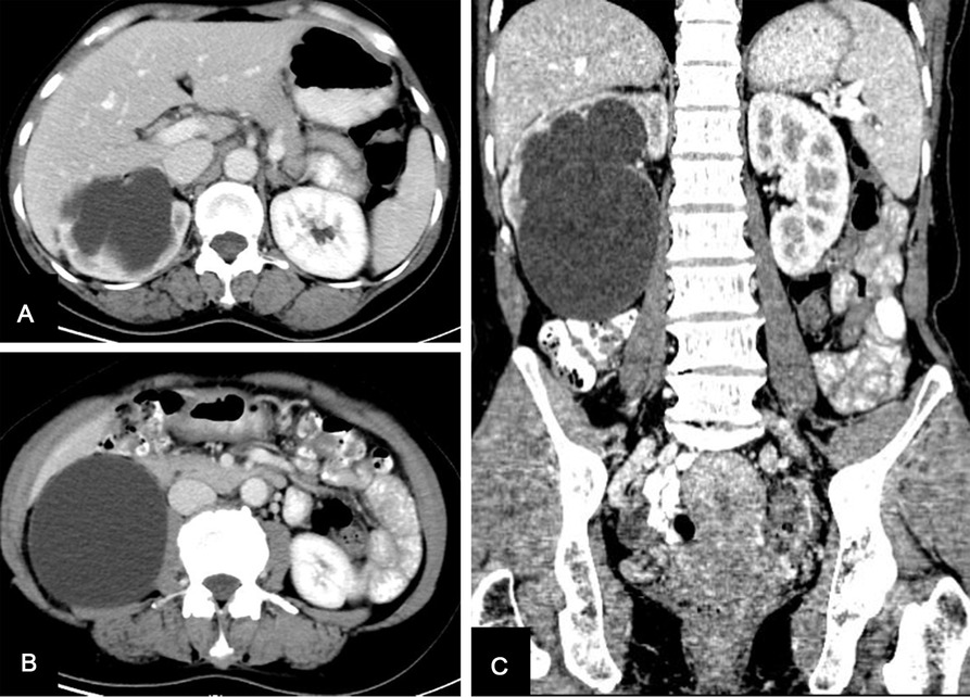 Frontiers Prolonged Postoperative Urine Leakage Due To A Calyceal Frontiers Prolonged Postoperative Urine Leakage Due To A Calyceal