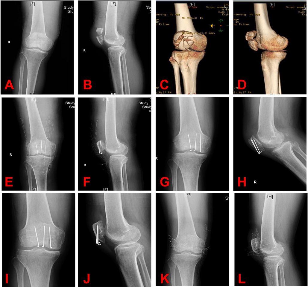 Frontiers Clinical Application Of Kirschner Wires Combined With 5