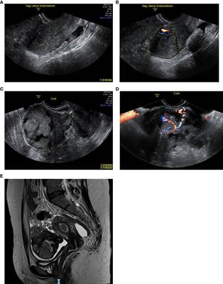 Frontiers | Case report: Spontaneous remission of synchronous ...