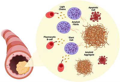 Frontiers | Localized light chain amyloidosis: A self-limited ...