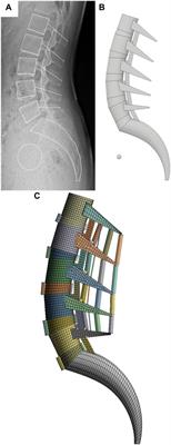 Frontiers | Spinal stability analysis of lumbar interbody fusion ...