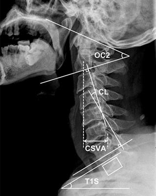 Frontiers | The discrepancy between preoperative cervical sagittal ...