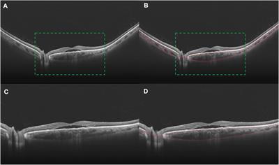 Frontiers | Wide-field OCT-angiography assessment of choroidal ...