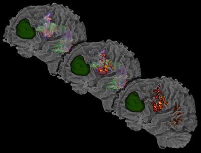 Frontiers | Tractography-based navigated TMS language mapping protocol