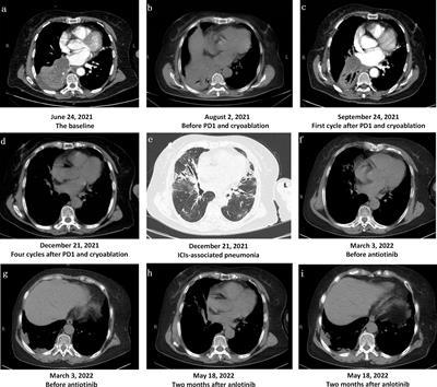 Frontiers | Significant response of pulmonary sarcomatoid carcinoma ...