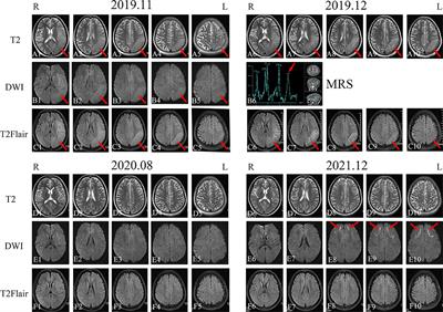 Frontiers | Case report: Two siblings with neuronal intranuclear ...
