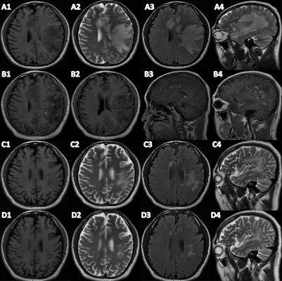 Frontiers | Case report: MOG-IgG-associated encephalitis with Epstein ...