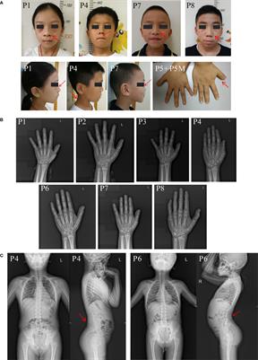 Frontiers | Description of the molecular and phenotypic spectrum in ...