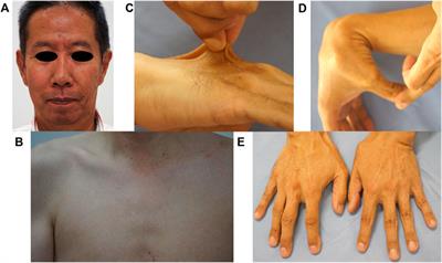 Frontiers | Case report: Mild phenotype of a patient with vascular ...