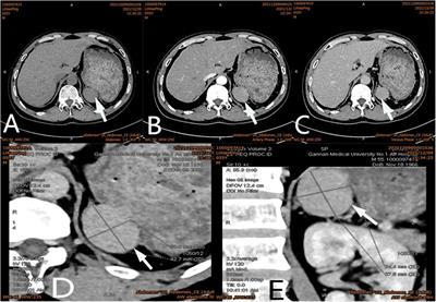 Frontiers | Case report: Misdiagnosis of accessory spleen in the left ...