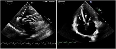 Frontiers | Single center experience and early outcomes of Impella 5.5