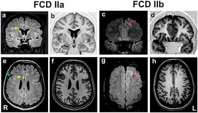Frontiers | Transcriptome analyses of the cortex and white matter of ...