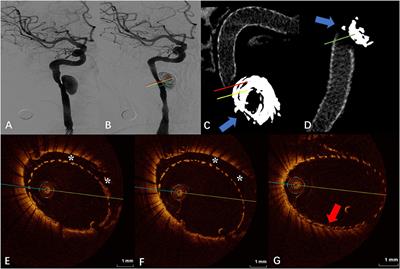 Frontiers | Evaluation of the apposition in unruptured aneurysms ...