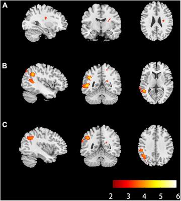 Frontiers | Diffusion kurtosis imaging and diffusion tensor imaging ...
