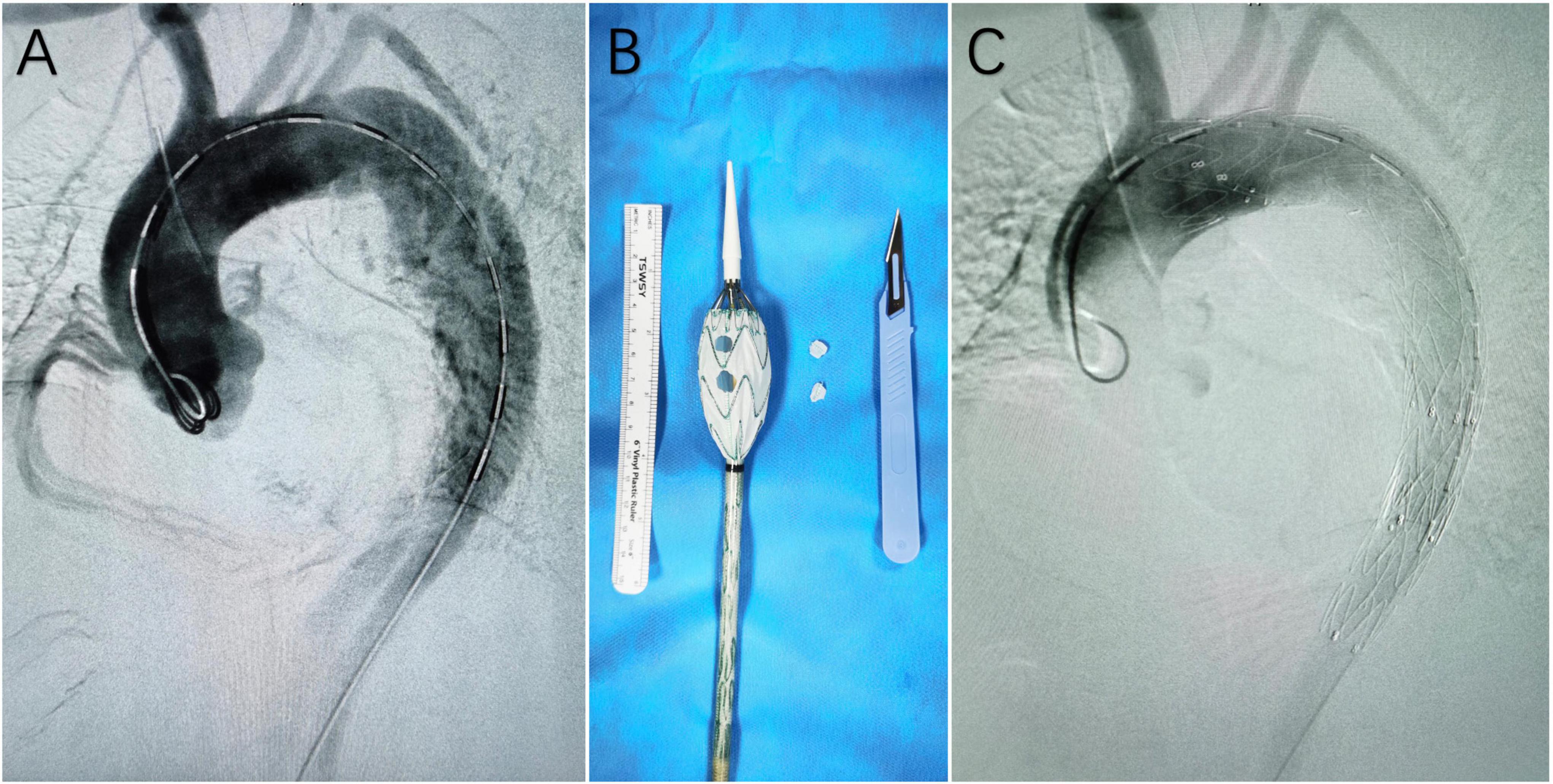 Frontiers | Outcomes of thoracic endovascular aortic repair with ...