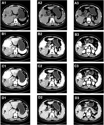 Frontiers | Case Report: A rare case of primary paraganglioma of the ...