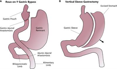 Frontiers | Bariatric Surgery: Targeting pancreatic β cells to treat ...