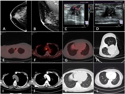 Frontiers | Primary squamous cell carcinoma of the breast: A case ...