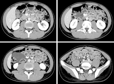 Frontiers | Case report: A mesocolic lymphangioma in a 14-year-old ...