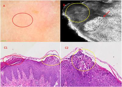 Frontiers | Case report: Infantile generalized pustular psoriasis with ...