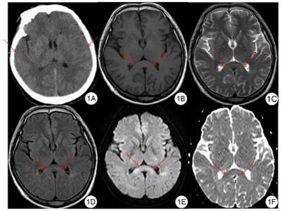 Frontiers | Study of high-altitude cerebral edema using multimodal imaging