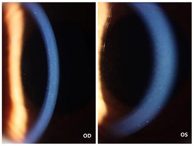 Frontiers | Case report: A case of corneal deposits between binocular ...