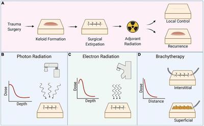Radiation Therapy Diagram