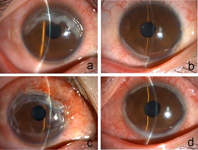 Frontiers | Peripheral ulcerative keratitis, nodular episcleritis, and ...