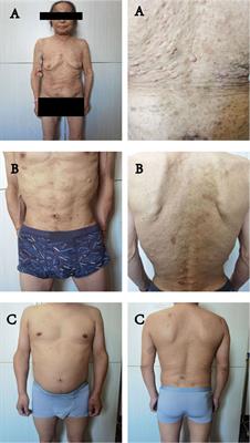 Frontiers | Case report: Neurofibromatosis type 1 gastrointestinal ...