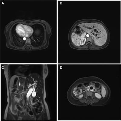 Frontiers | Avoiding misdiagnosis of duodenal papilla adenocarcinoma in ...