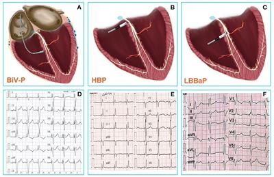 Frontiers | Success rates, challenges and troubleshooting of left ...