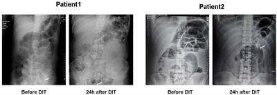 Frontiers | Short-term outcomes of deeper intubation technique of ileus ...