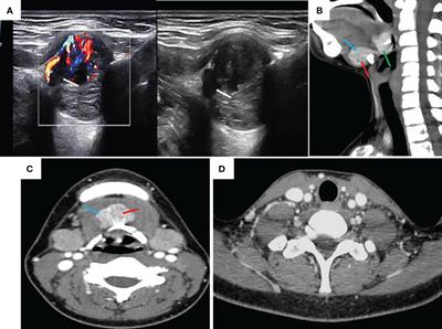 Frontiers | Diagnosis and treatment of ectopic thyroid carcinoma: A ...