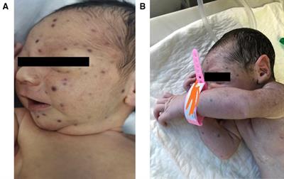 Frontiers | Case report: “Congenital cutaneous langerhans cell ...