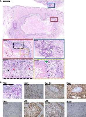 Frontiers | Systematic analysis and case series of the diagnosis and ...
