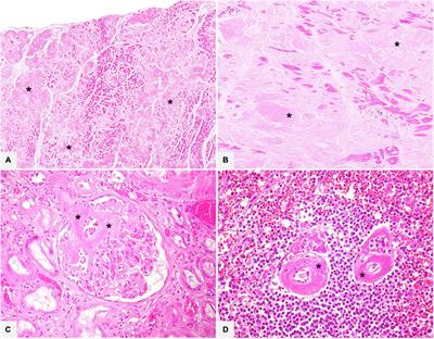 Frontiers | Amyloidosis: What does pathology offer? The evolving field ...