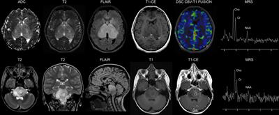 Frontiers | Pediatric diffuse midline glioma H3K27- altered: A complex ...