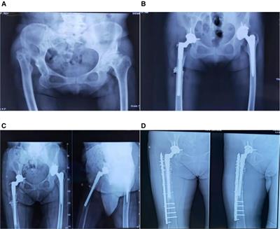 Frontiers | Implant loosening following THA with S-ROM prosthesis and ...