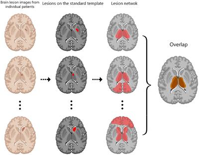 Frontiers | Functional and structural lesion network mapping in ...