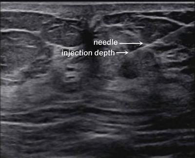 Frontiers | 99mTc-rituximab tracer injection for guiding internal ...