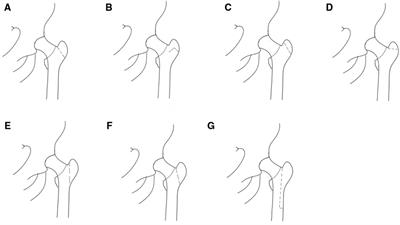 Frontiers | Greater trochanteric osteotomy and subtrochanteric ...