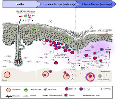 Lichen Planus Histological Features