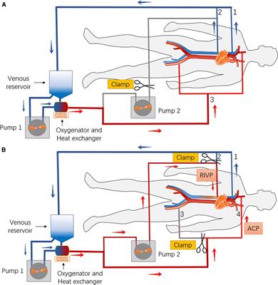 Cardiopulmonary Bypass Diagram